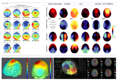 QEEG or quantitative EEG brain maps is the first step in helping you improve the quality of your ...