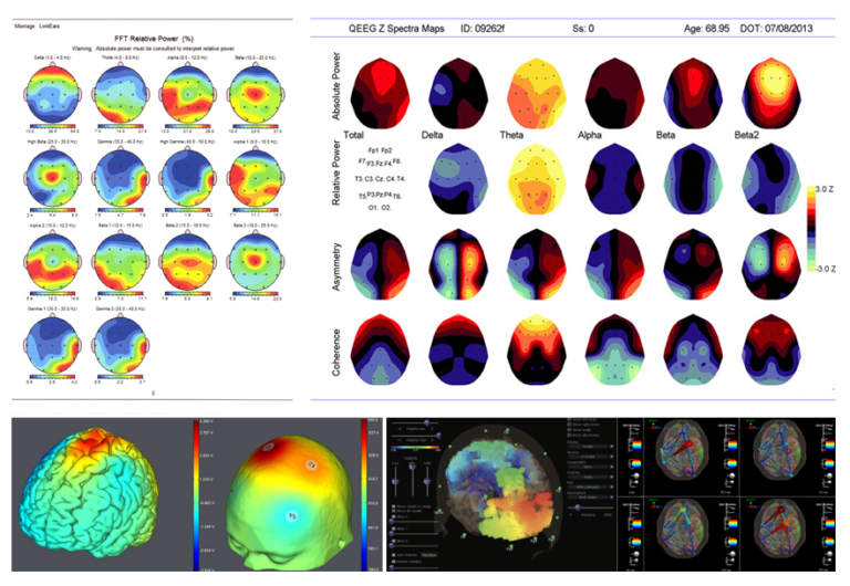 QEEG or quantitative EEG brain maps is the first step in helping you ...